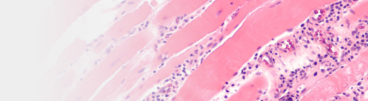 Laboratory Evaluation of Inflammatory Myopathies | ARUP Laboratories